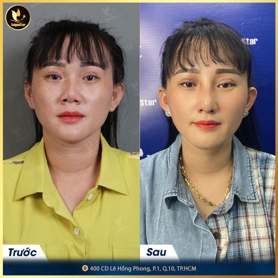 Cắt cánh mũi bao lâu thì lành? Chăm sóc hậu phẫu