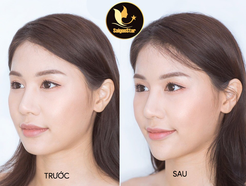 Filler và Botox khác nhau như thế nào?