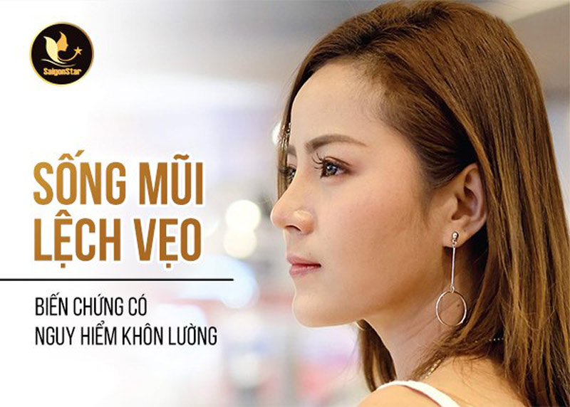 Sống mũi lệch vẹo - Biến chứng nguy hiểm khôn lường